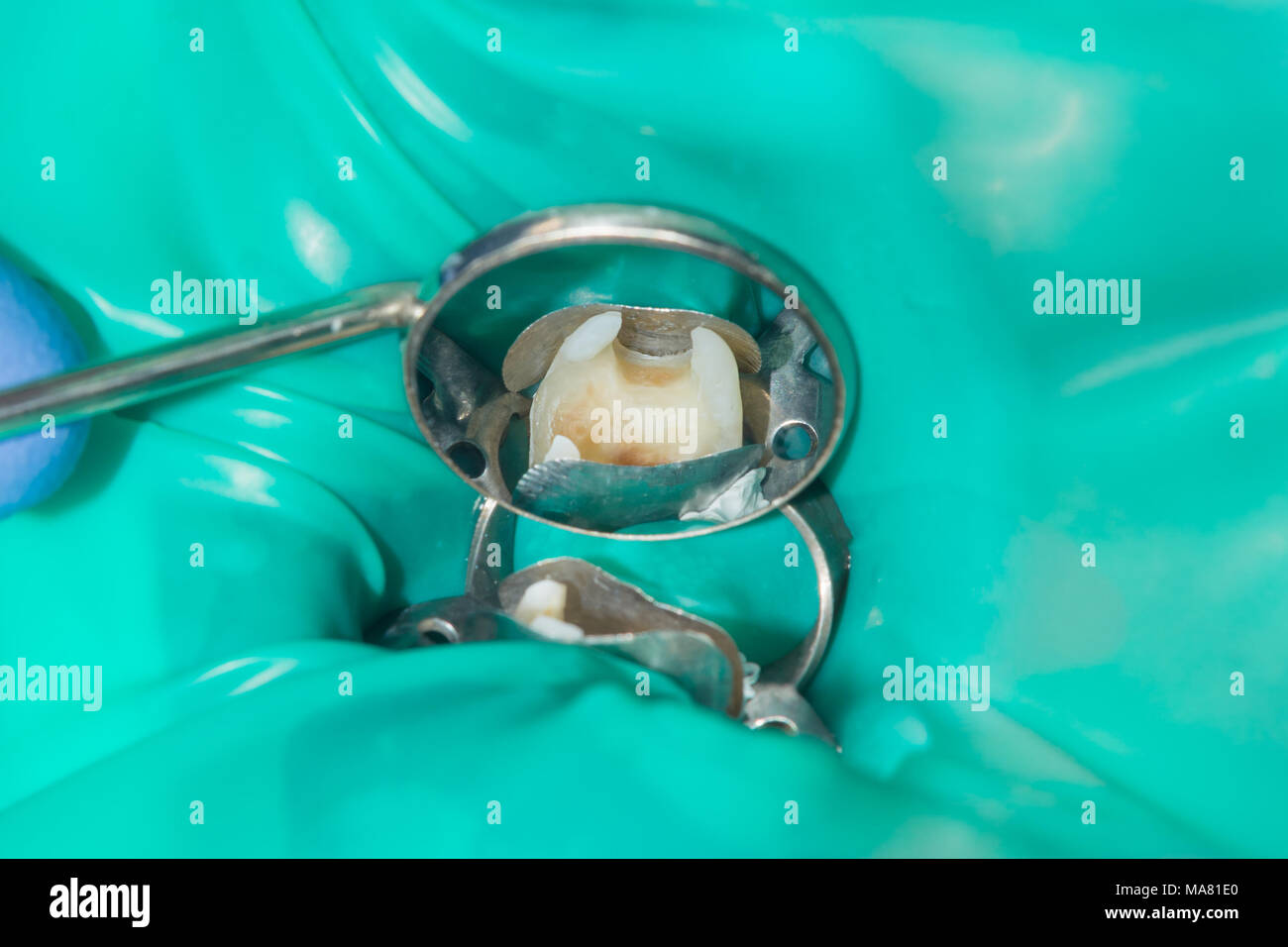 Treatment of the roots of the tooth. Sealing and cleaning a carious ...