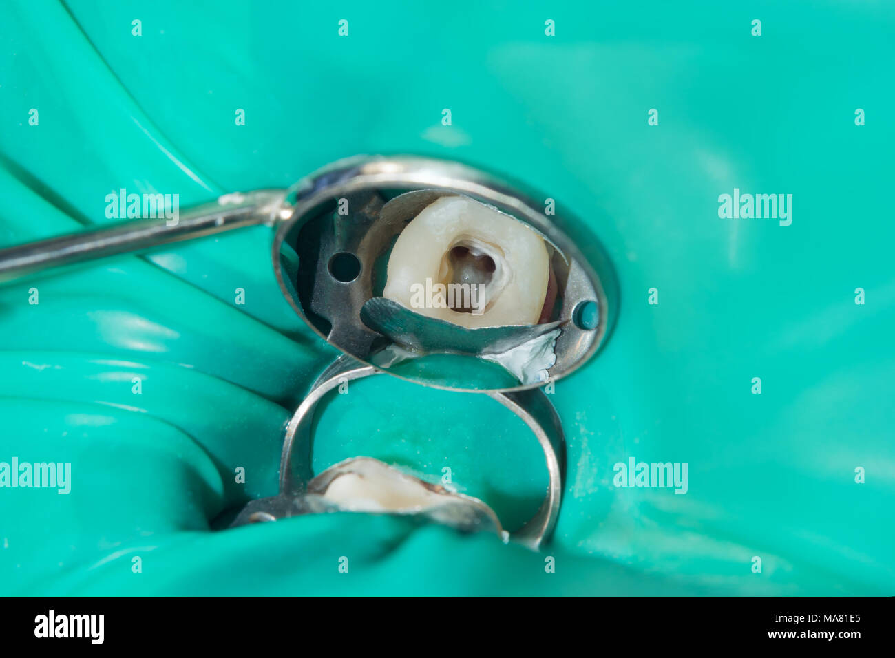 Treatment of the roots of the tooth. Sealing and cleaning a carious ...