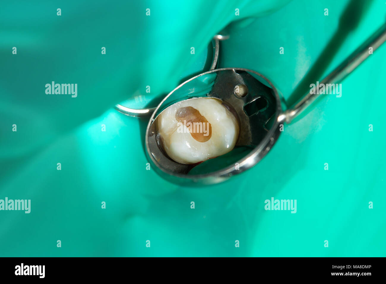 caries spoiled tooth closeup photographed through dental mirror Stock ...