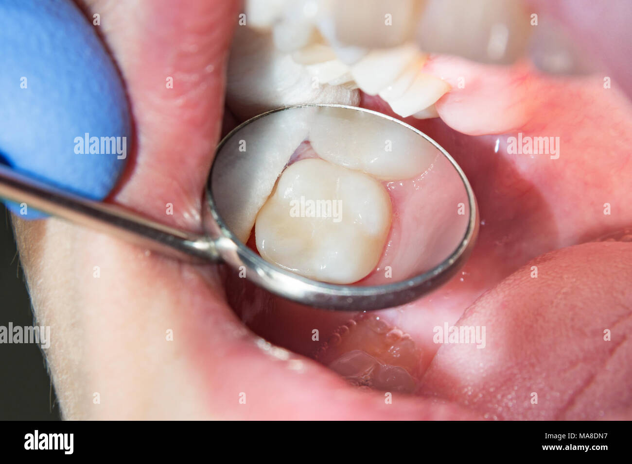 caries spoiled tooth closeup photographed through dental mirror Stock ...