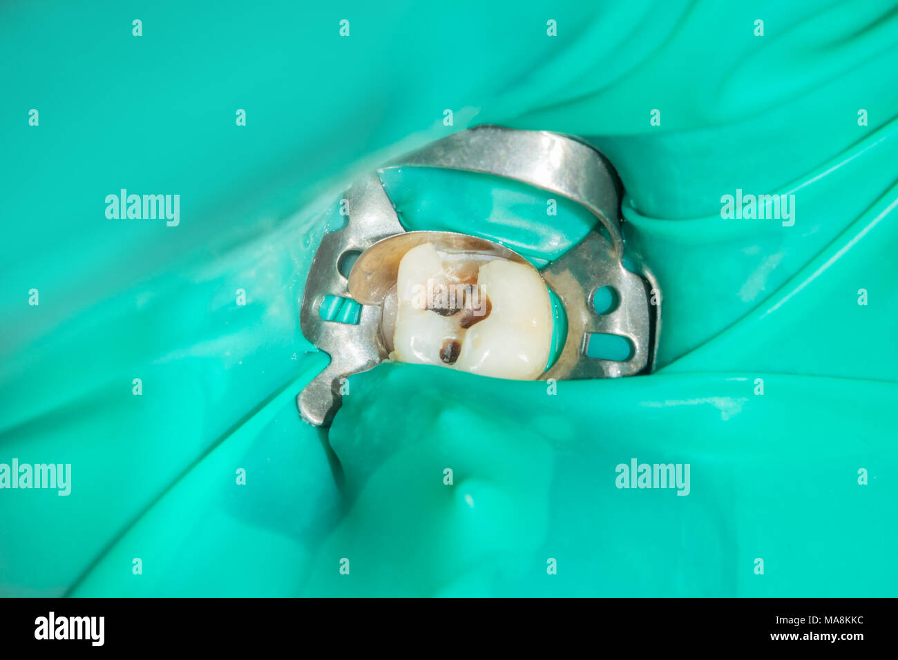 caries spoiled tooth closeup photographed through dental mirror Stock ...