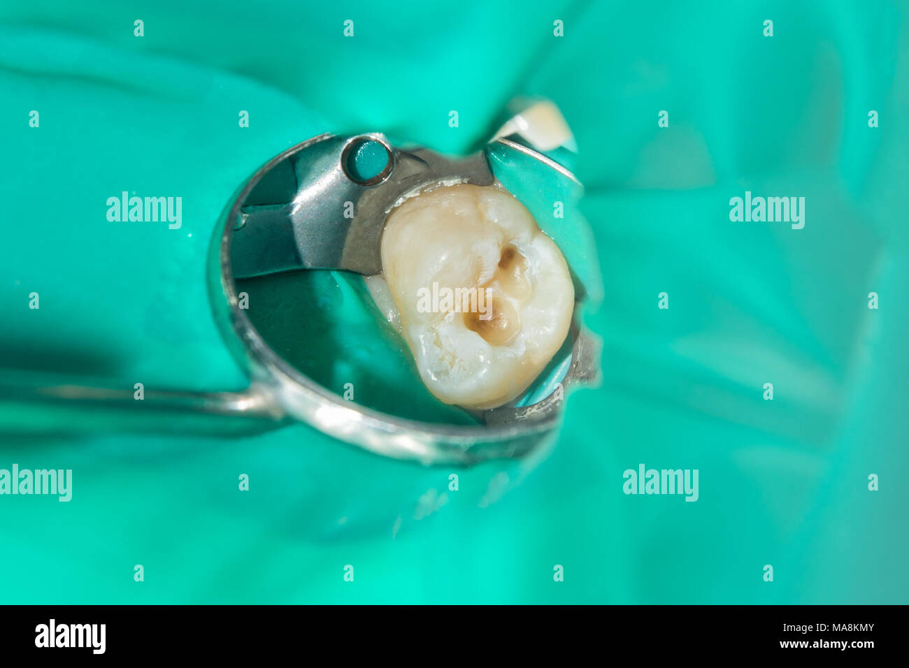 caries spoiled tooth closeup photographed through dental mirror Stock ...