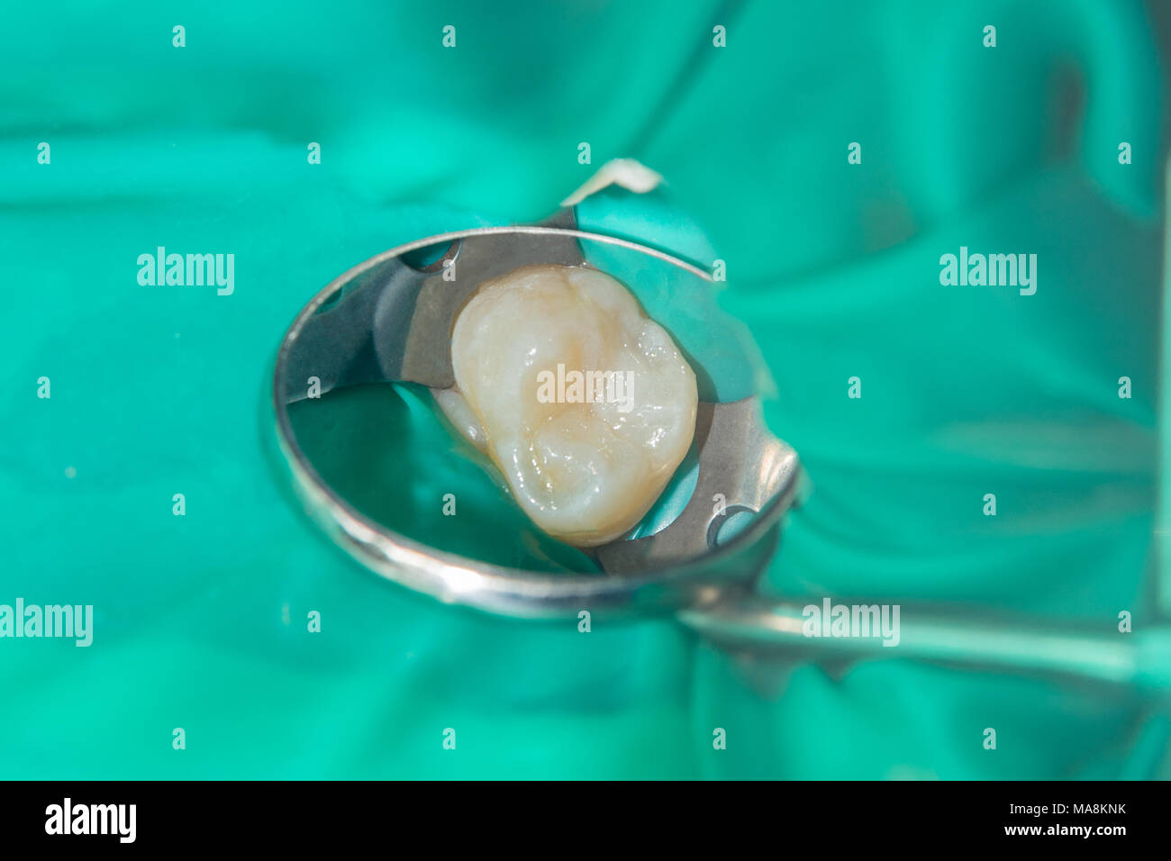 close-up of a human rotten carious tooth at the treatment stage in a ...