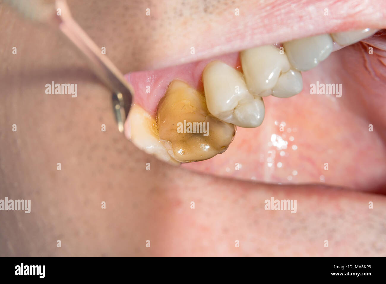caries spoiled tooth closeup photographed through dental mirror Stock ...