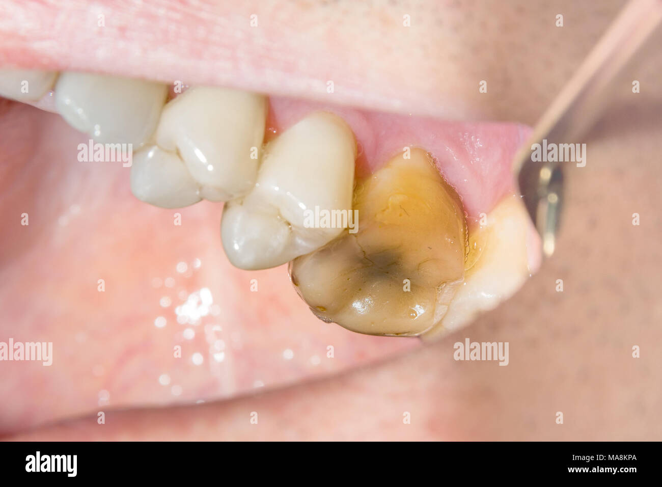 close-up of a human rotten carious tooth at the treatment stage in a ...