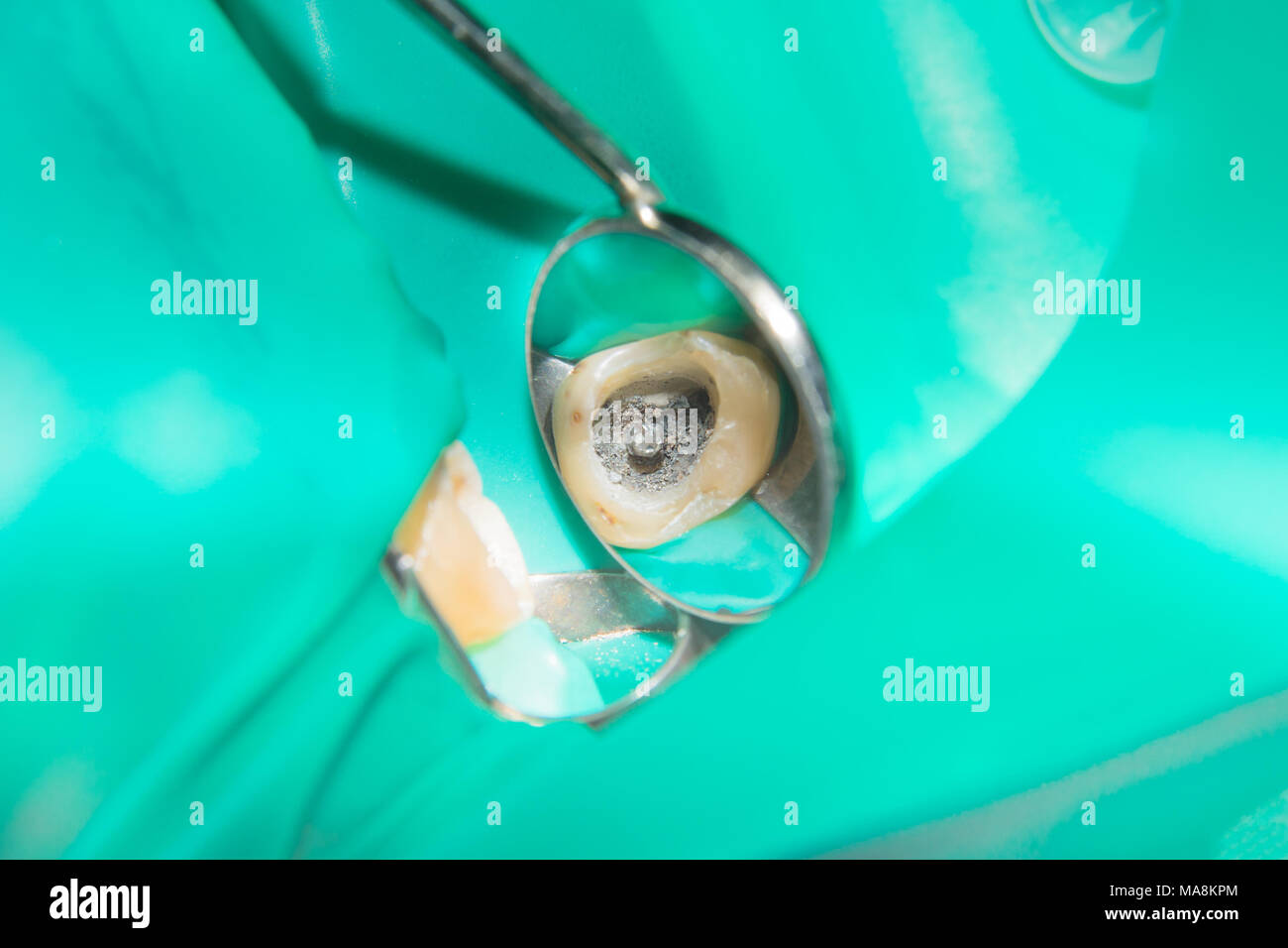 caries spoiled tooth closeup photographed through dental mirror Stock ...