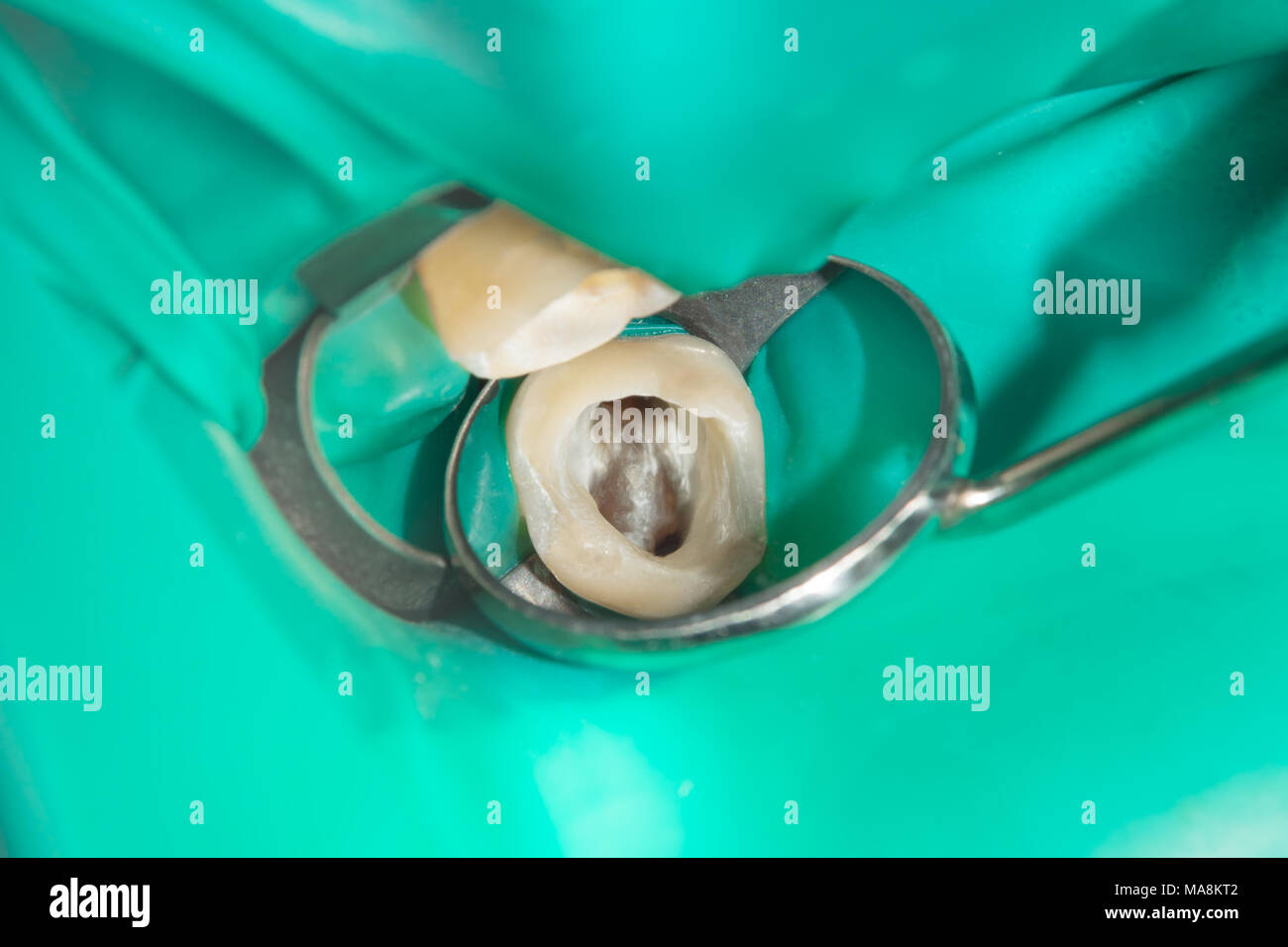 close-up of a human rotten carious tooth at the treatment stage in a ...