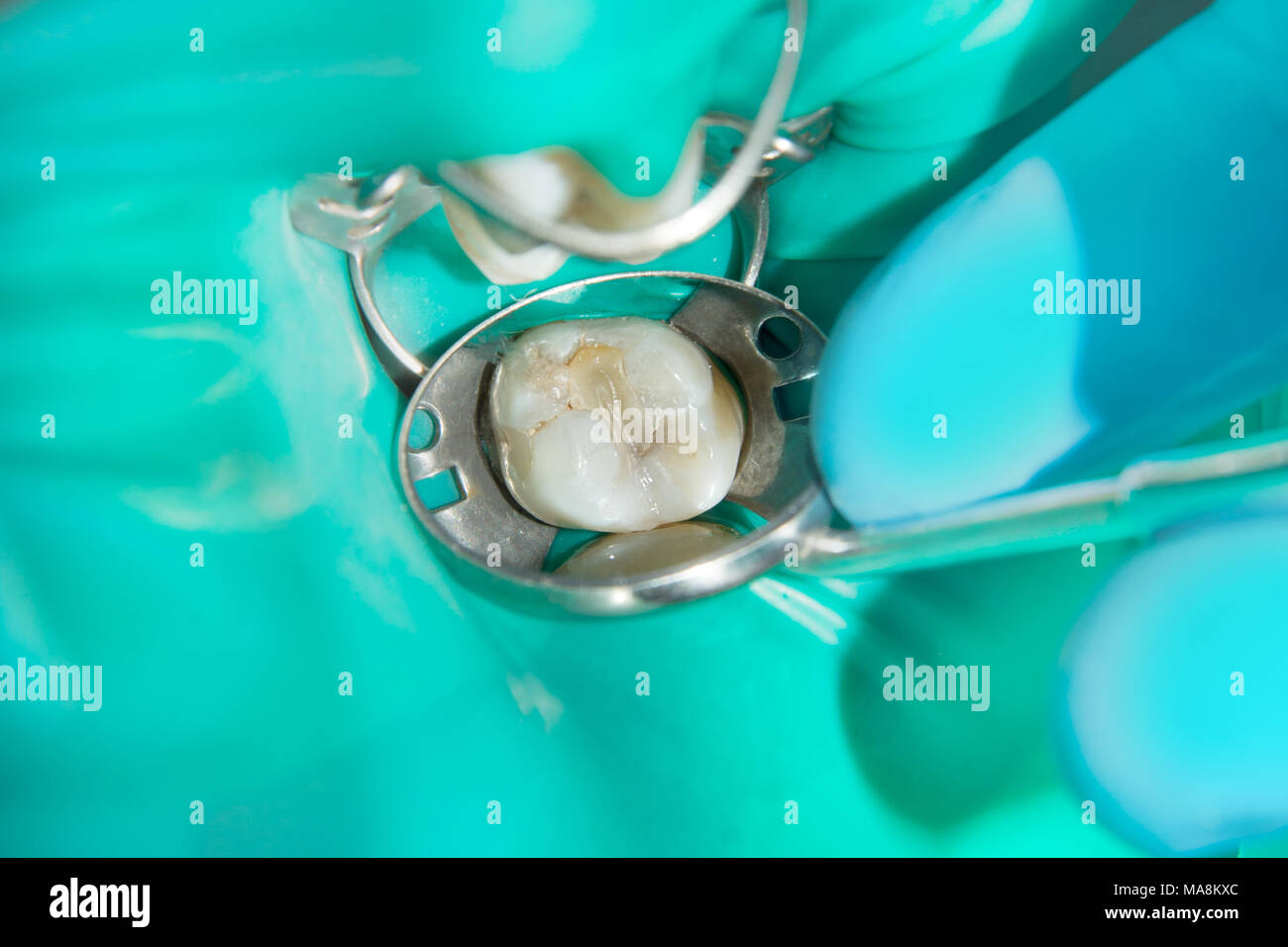 caries spoiled tooth closeup photographed through dental mirror Stock ...