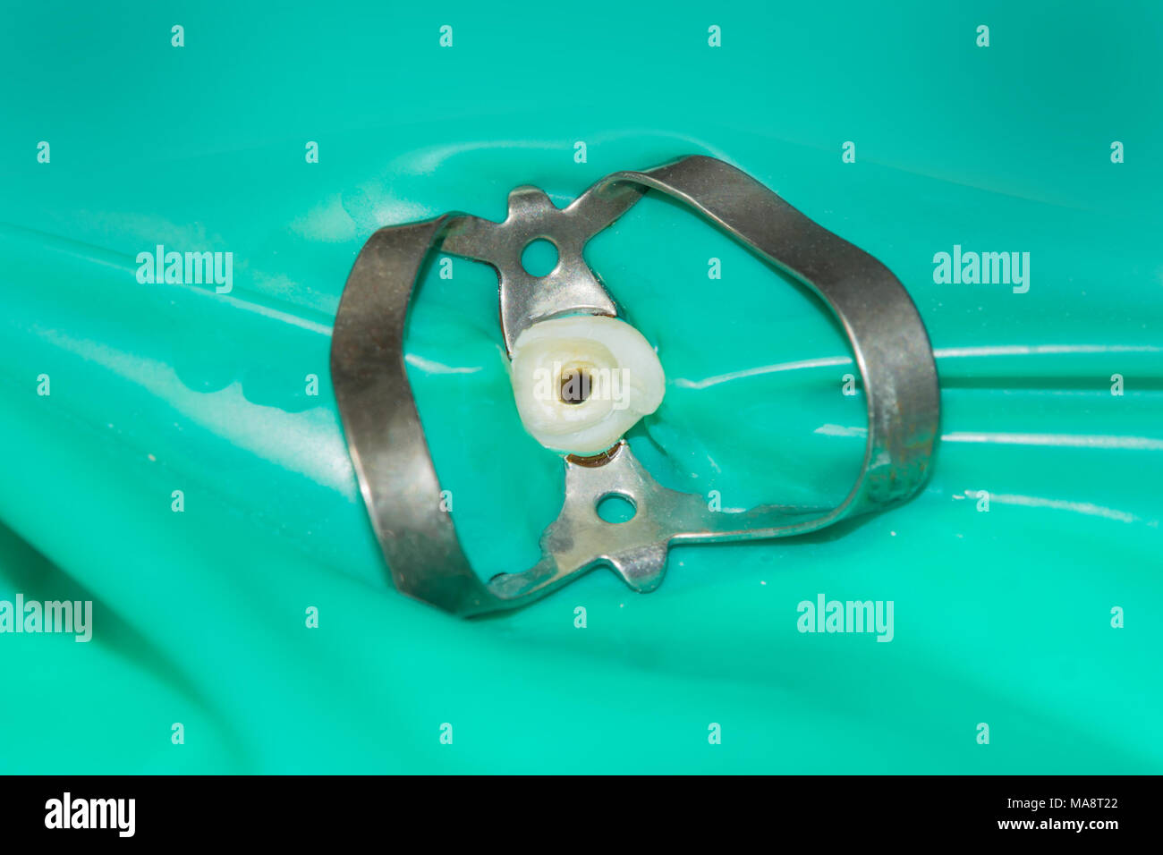 photo endodontic treatment of dental canals in the lower molar ...