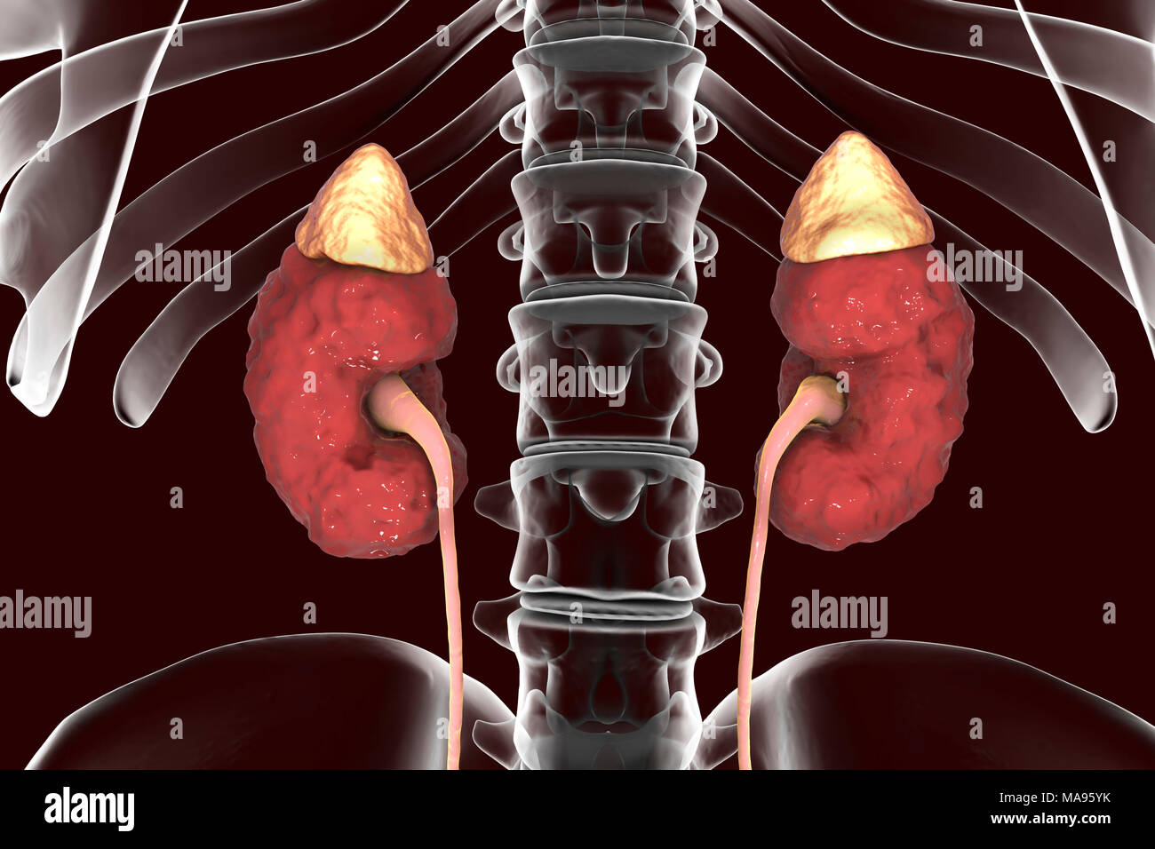 Chronic kidney disease. Computer illustration showing the gross anatomy ...