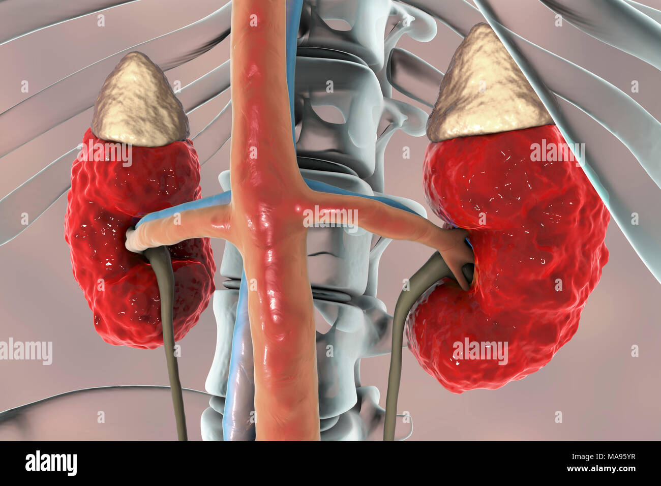 Chronic kidney disease. Computer illustration showing the gross anatomy ...