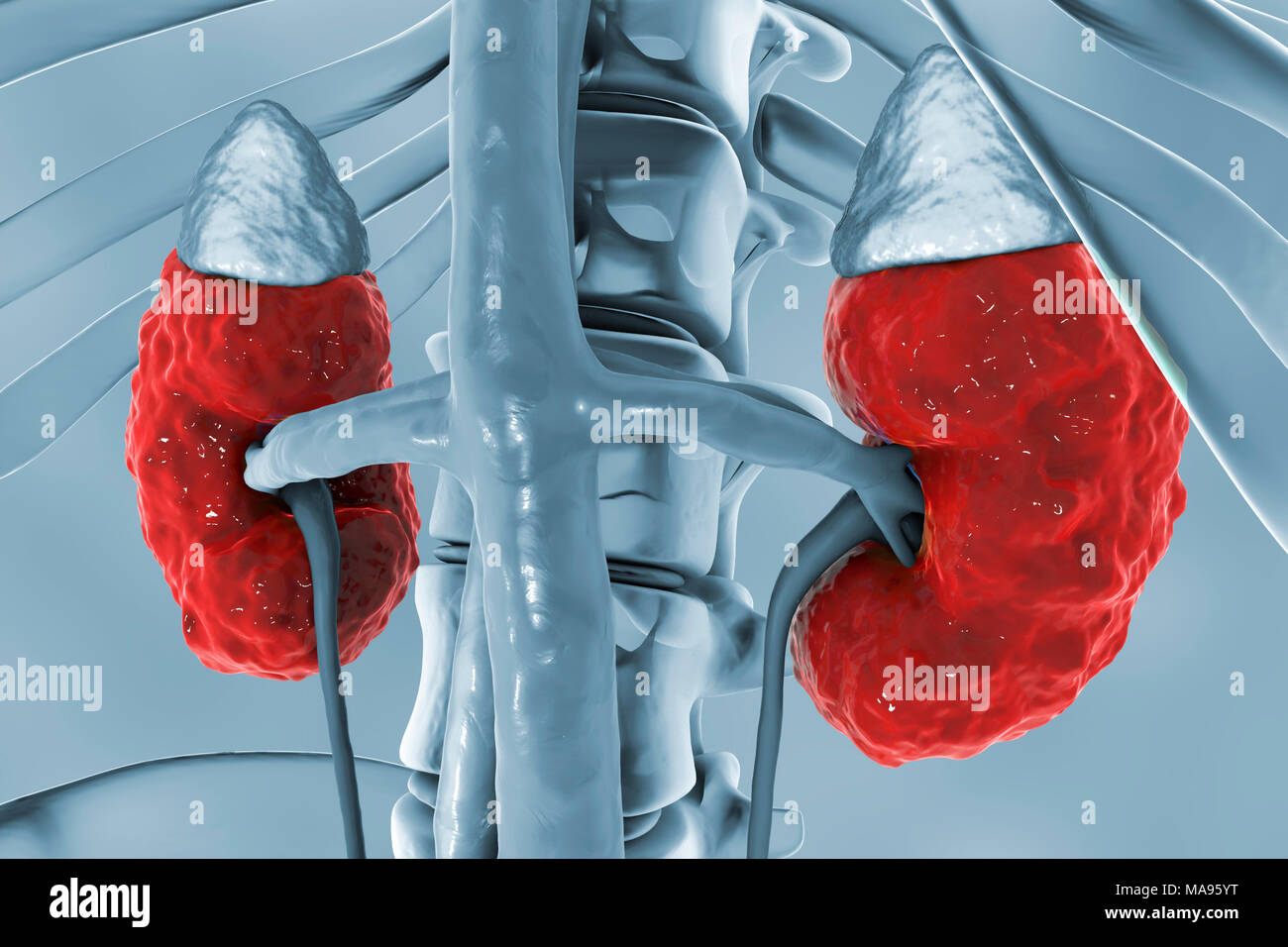 Chronic kidney disease. Computer illustration showing the gross anatomy ...