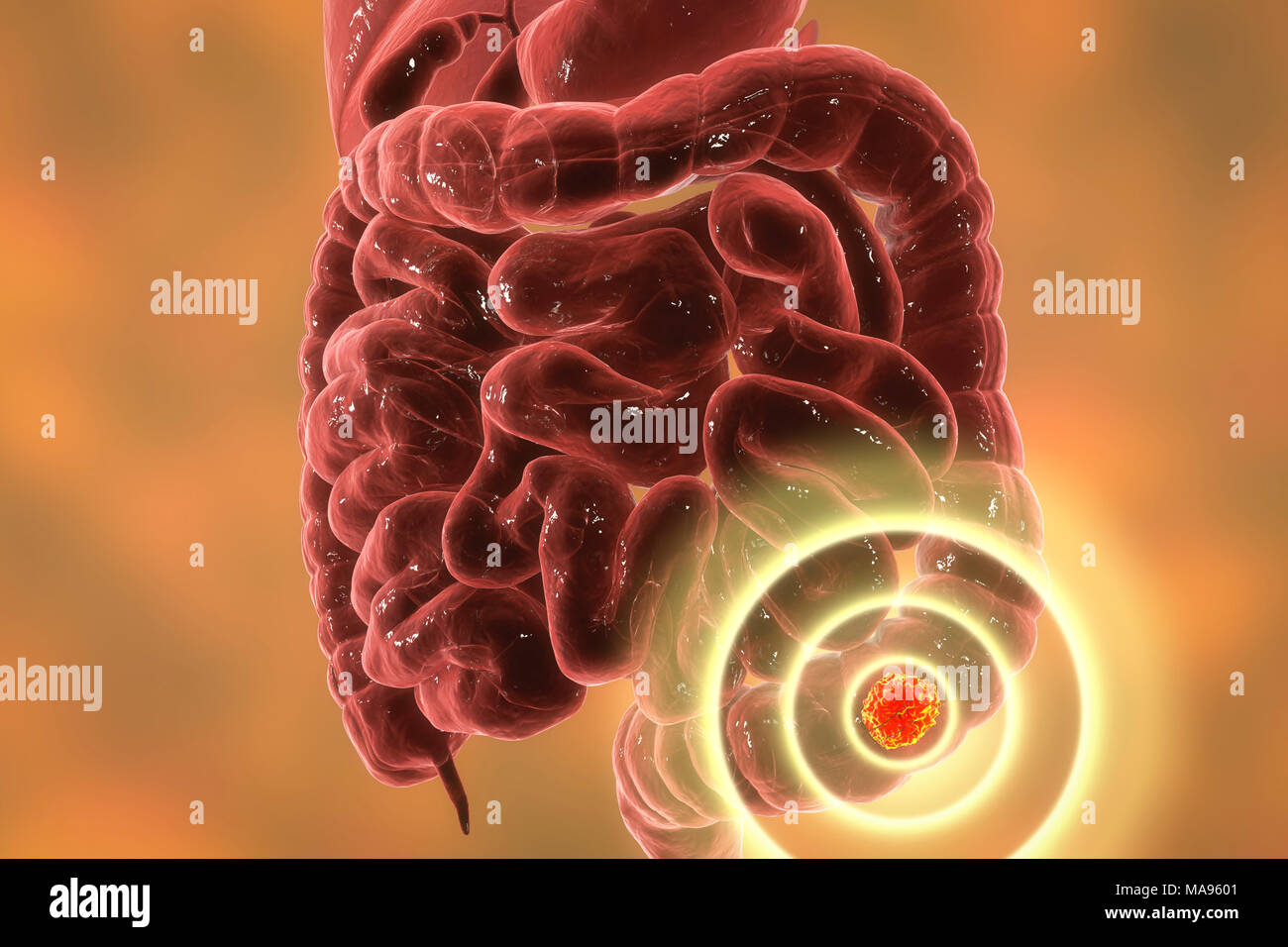 Colon cancer treatment, conceptual computer illustration Stock Photo ...