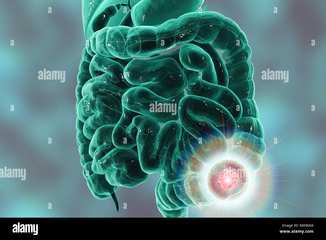 Colon cancer treatment, conceptual computer illustration Stock Photo ...