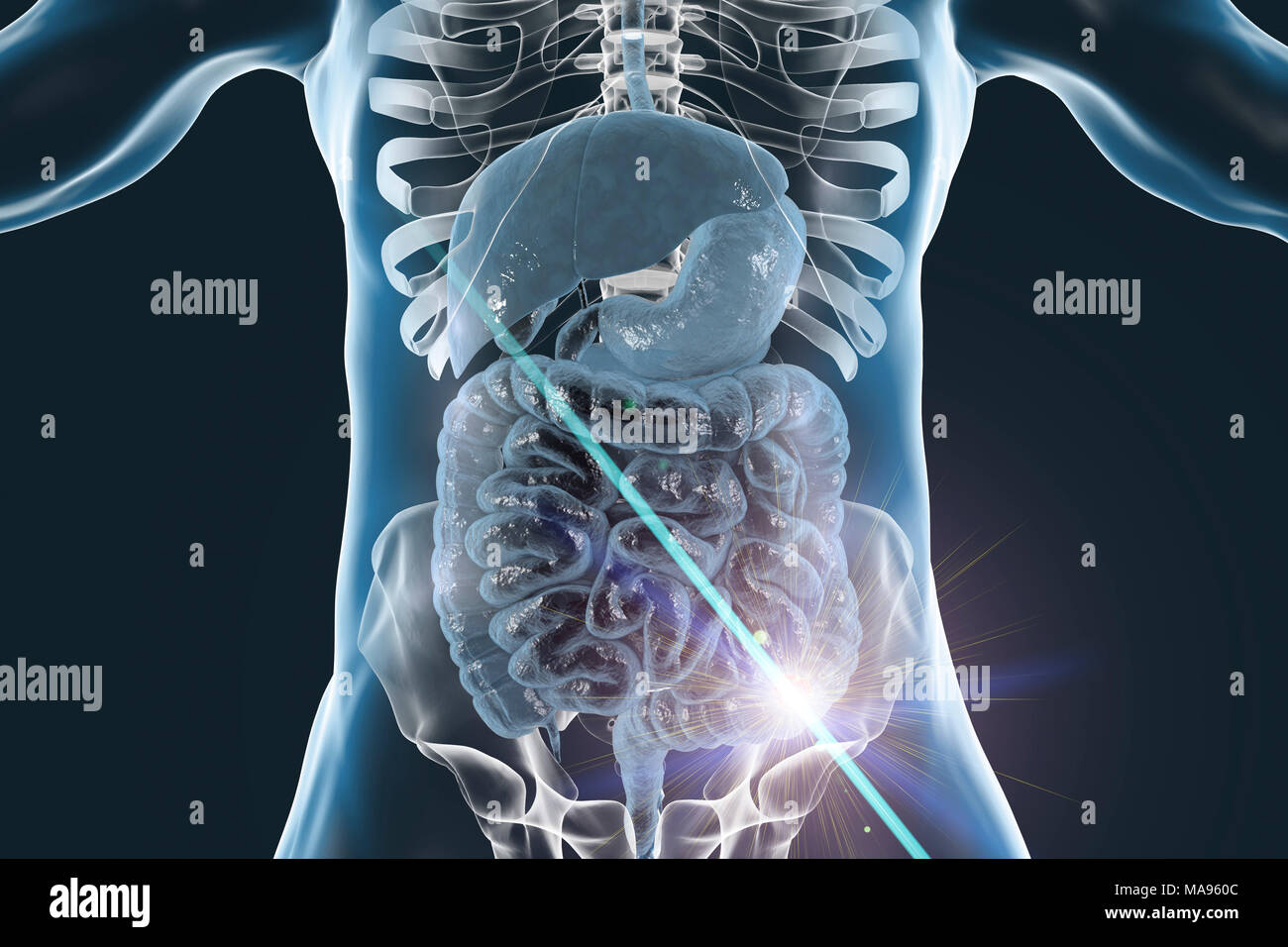 Colon cancer treatment, conceptual computer illustration Stock Photo ...