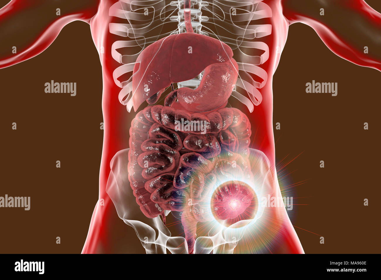 Colon cancer treatment, conceptual computer illustration Stock Photo ...