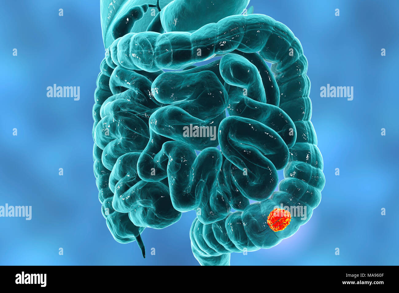 Colon cancer, computer illustration Stock Photo - Alamy