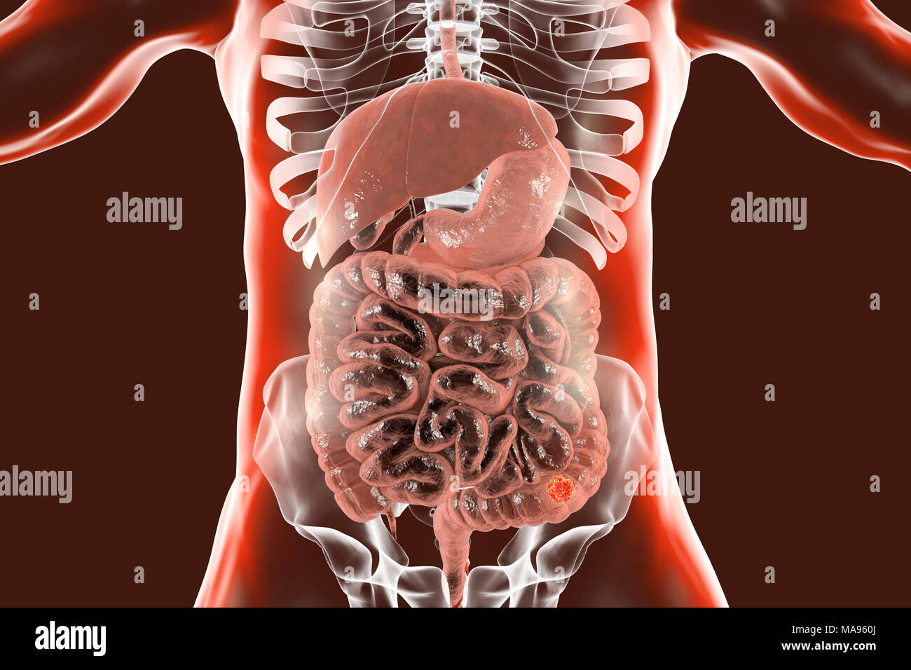 Colon cancer, computer illustration Stock Photo - Alamy