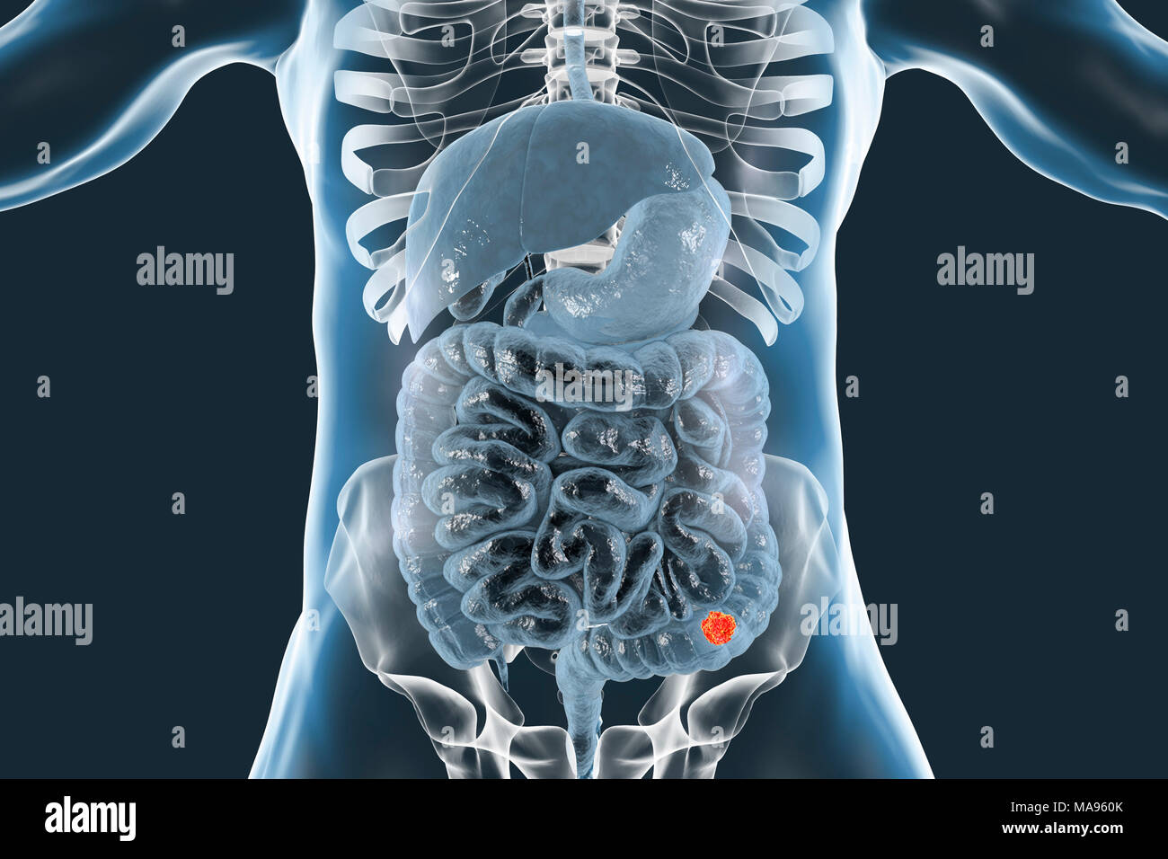 Colon cancer, computer illustration Stock Photo - Alamy