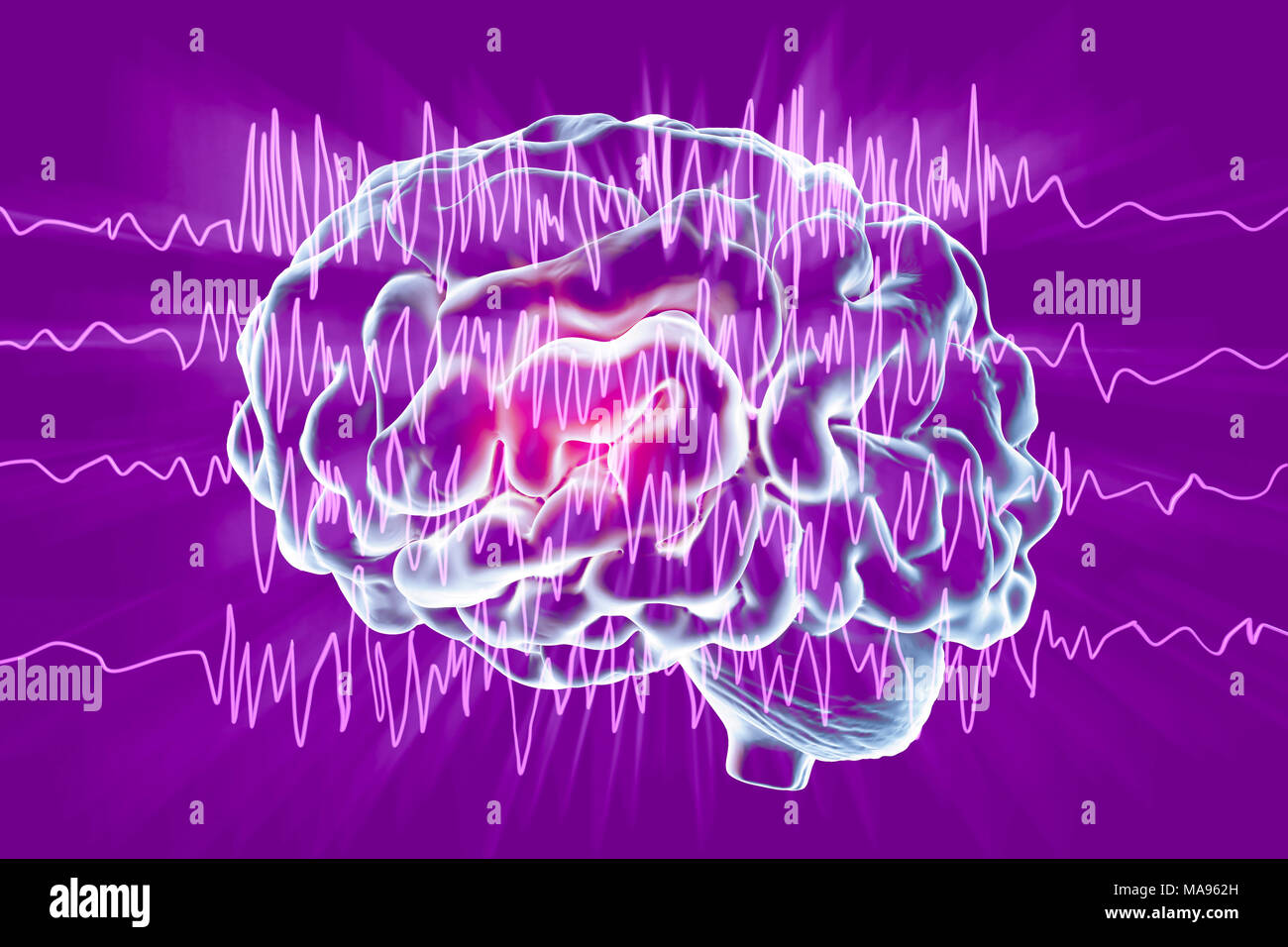 Generalized epilepsy hi-res stock photography and images - Alamy