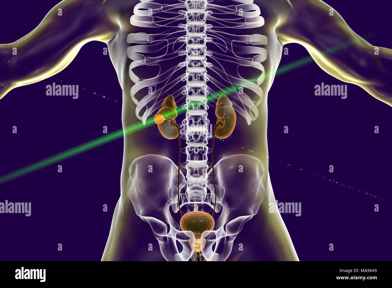 Kidney cancer laser photoablation treatment, conceptual computer ...