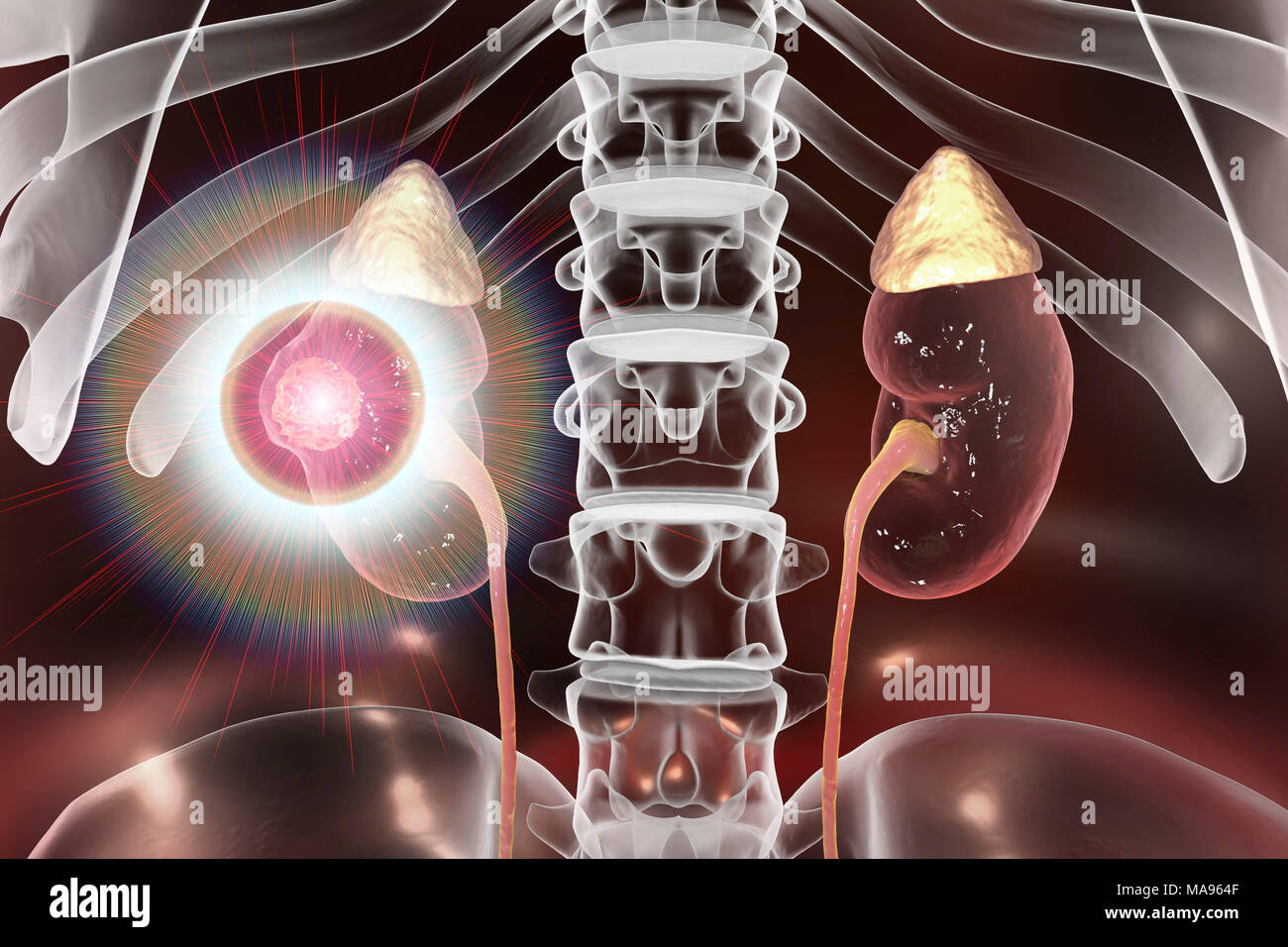 Kidney cancer treatment, conceptual computer illustration Stock Photo ...