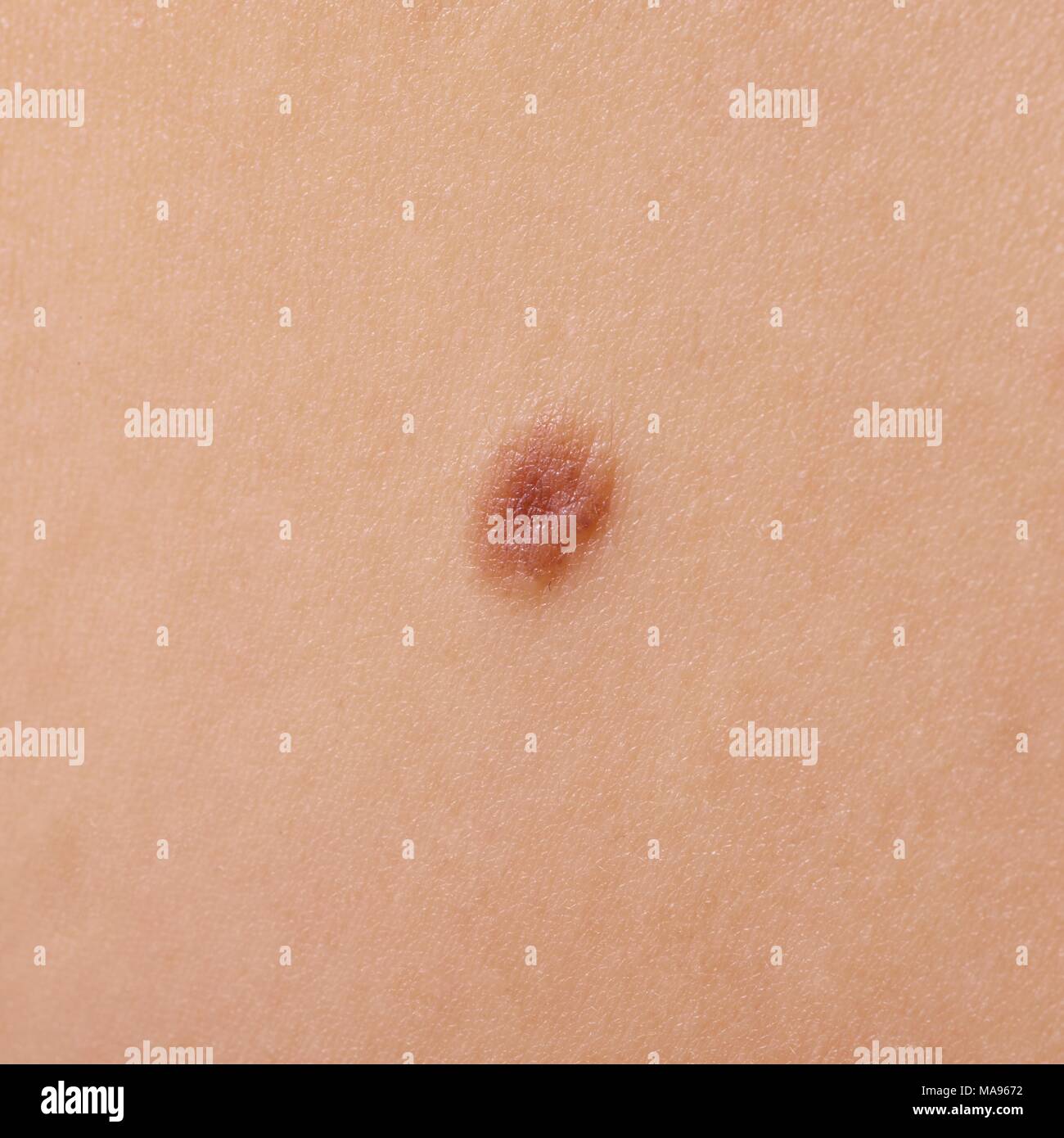 Mole on skin, close up Stock Photo - Alamy