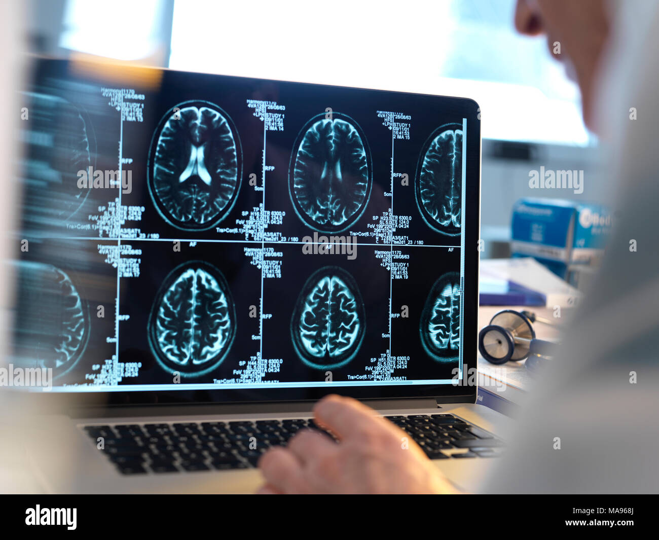 MODEL RELEASED. Doctor viewing a patient's brain scans on a computer ...