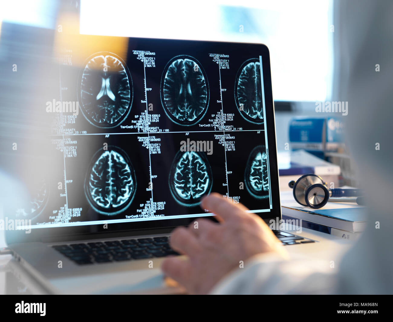 Dementia brain scans hi-res stock photography and images - Alamy