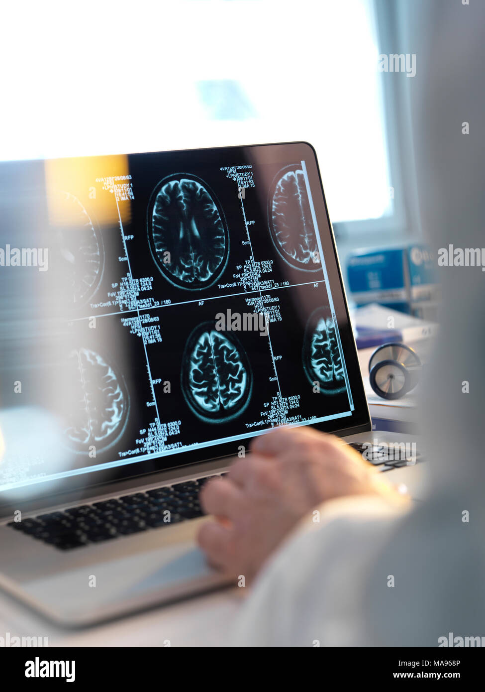 MODEL RELEASED. Doctor viewing a patient's brain scans on a computer ...