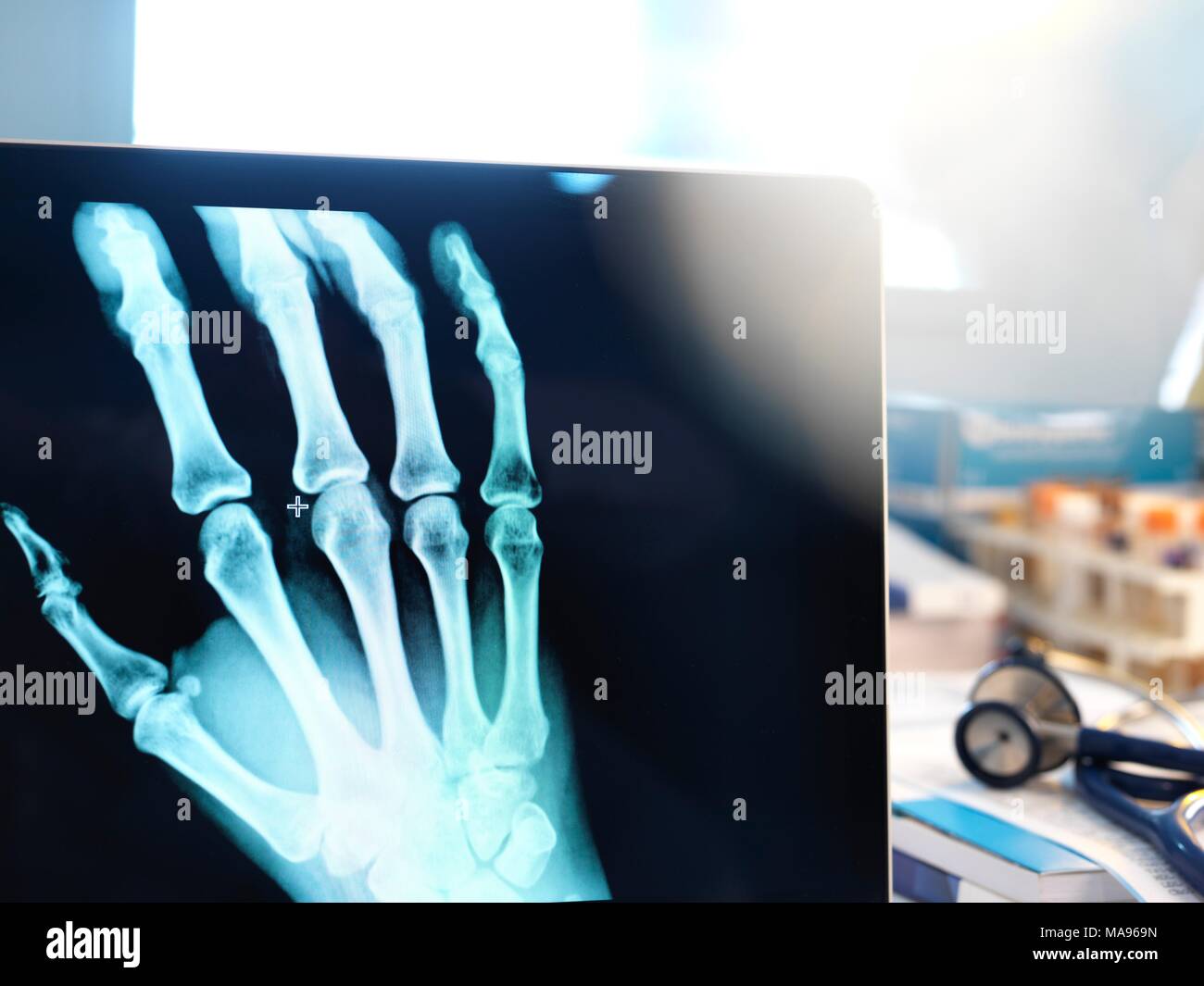 MODEL RELEASED. Doctor viewing an X-ray of a hand on a computer screen ...