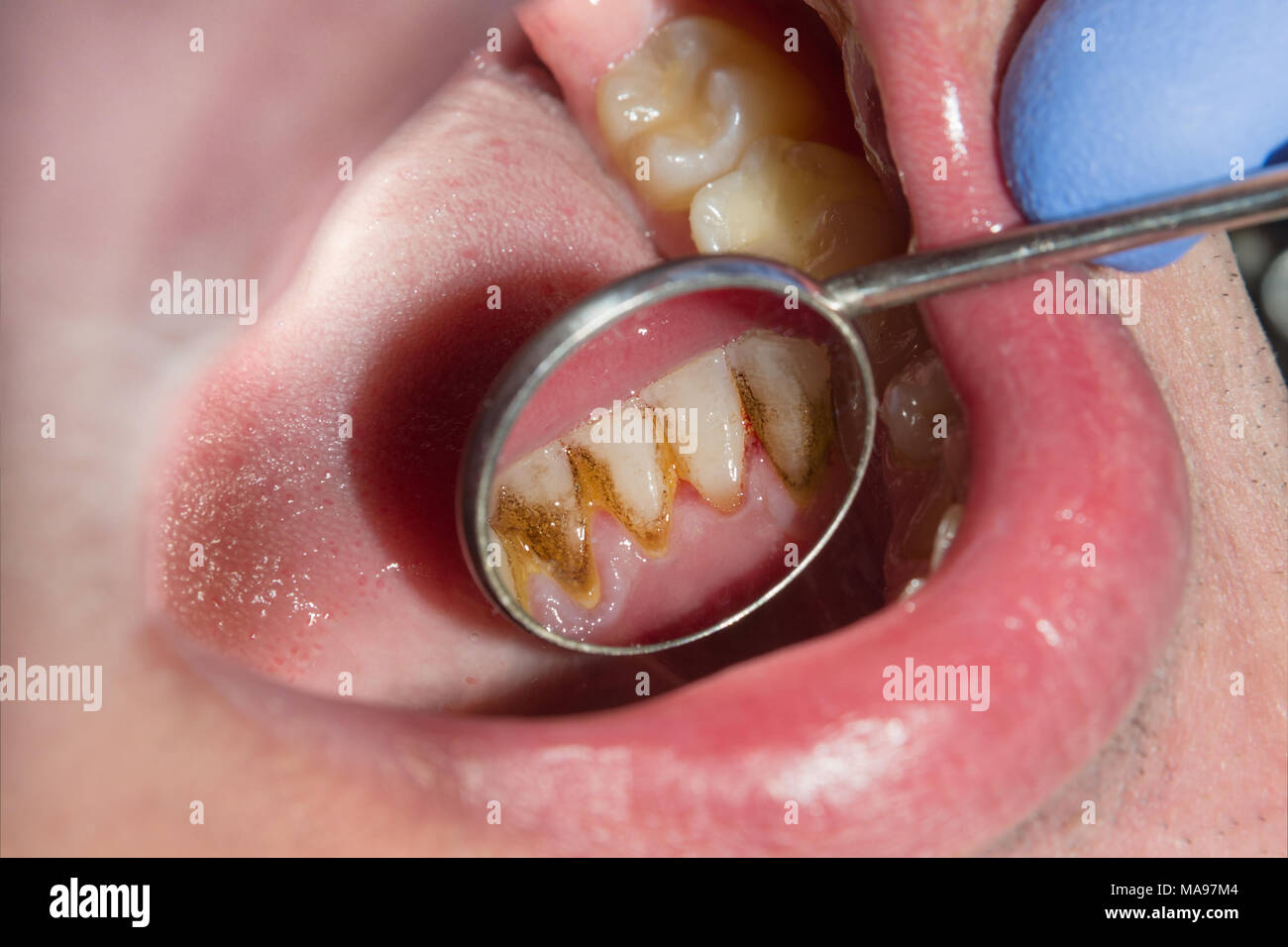 Dental plaque hi-res stock photography and images - Alamy