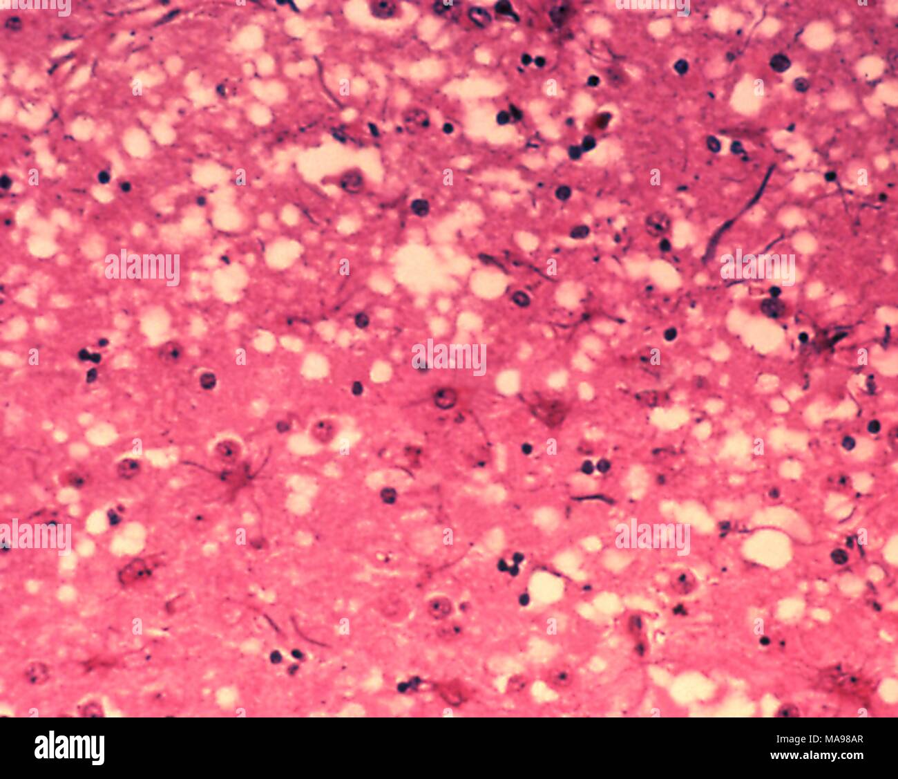 Healthy Brain Tissue