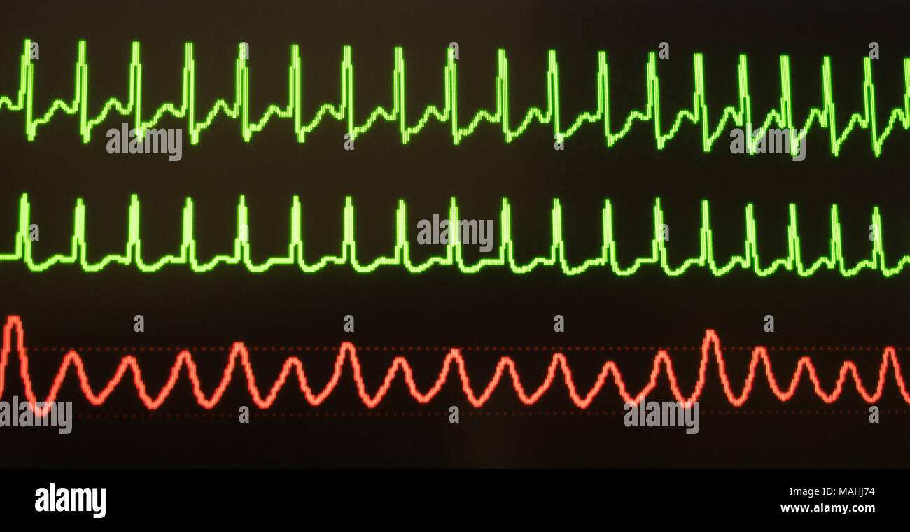 Monitor showing supraventricular tachycardia in green and arterial ...
