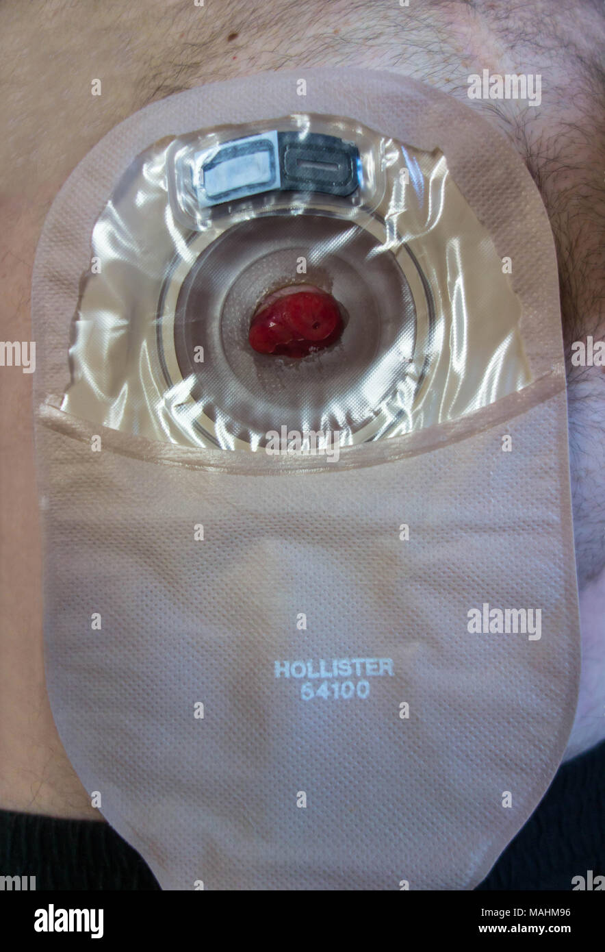 Ileostomy bag pouch hi-res stock photography and images - Alamy