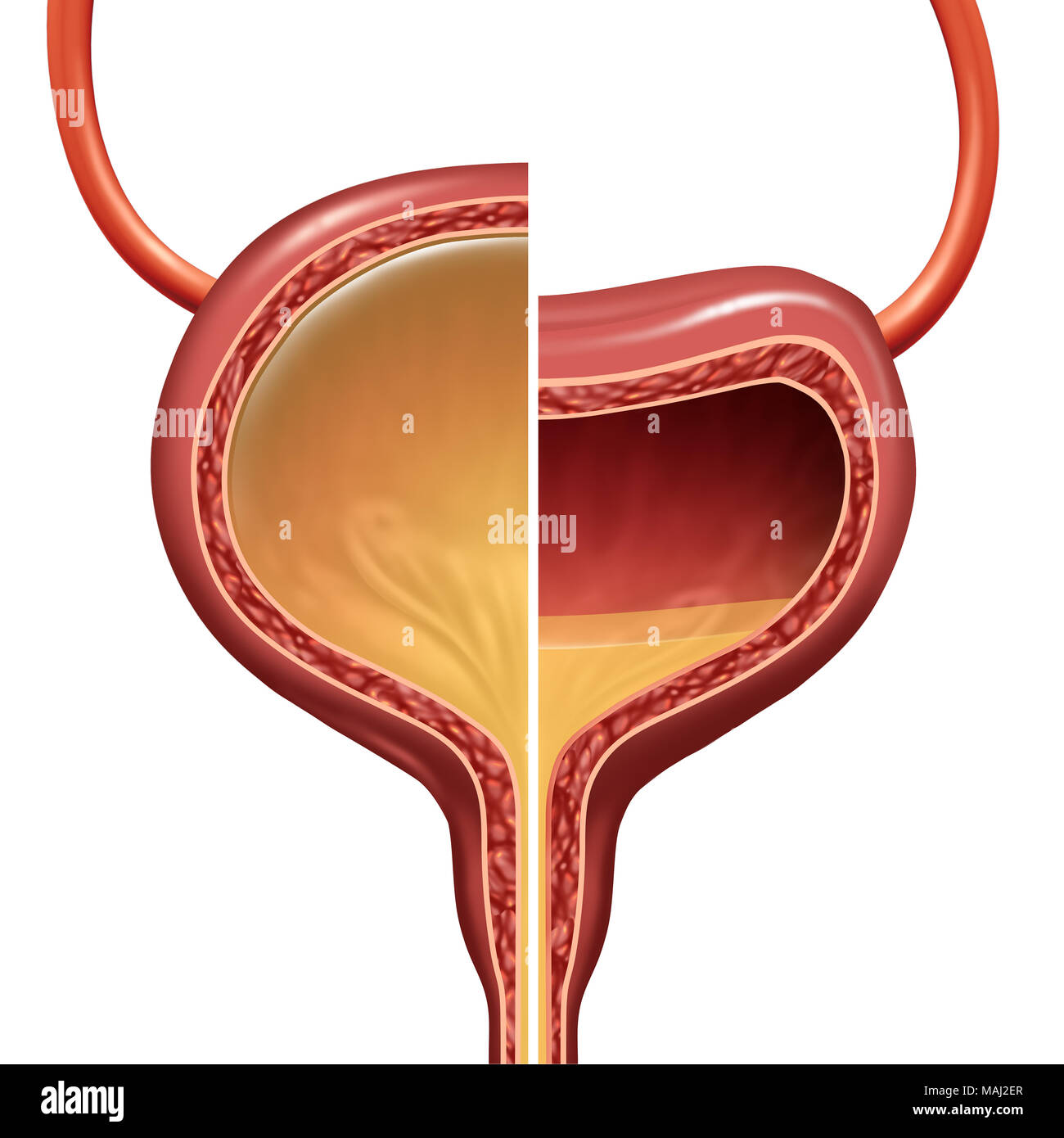 Bladder as a normal and overactive urinary organ comparison ...