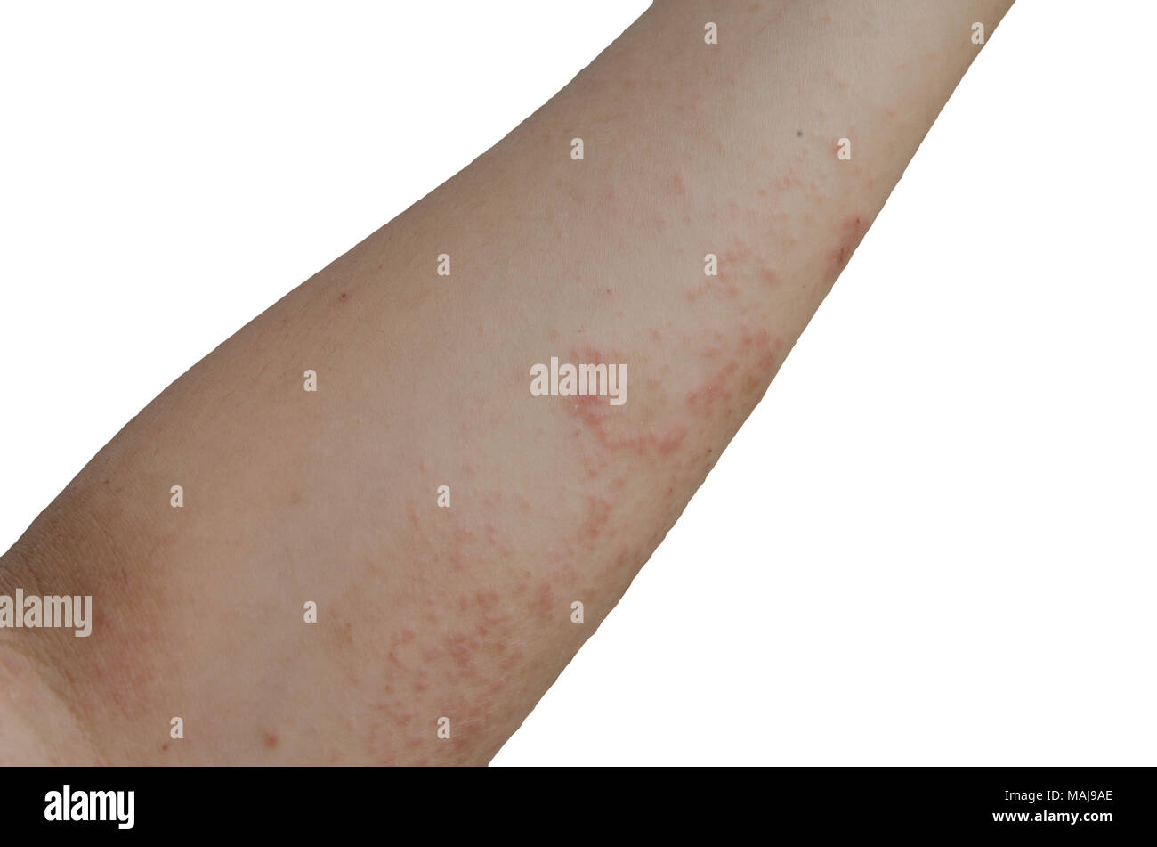 Rash and skin on the arms, isolated on white background. with clipping ...