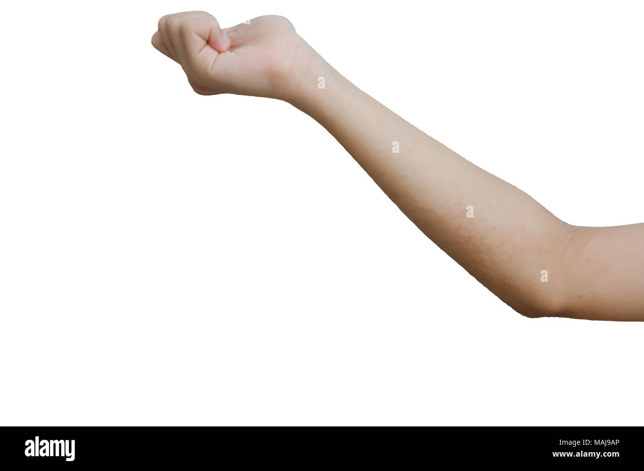 Rash and skin on the arms, isolated on white background. with clipping ...