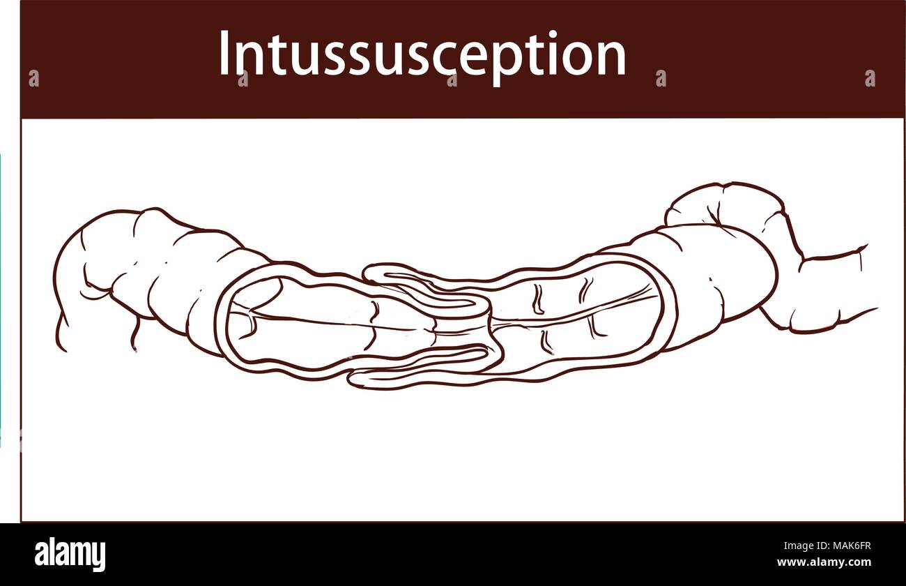 vector illustration of intussusception of intestine. obstruction Stock ...