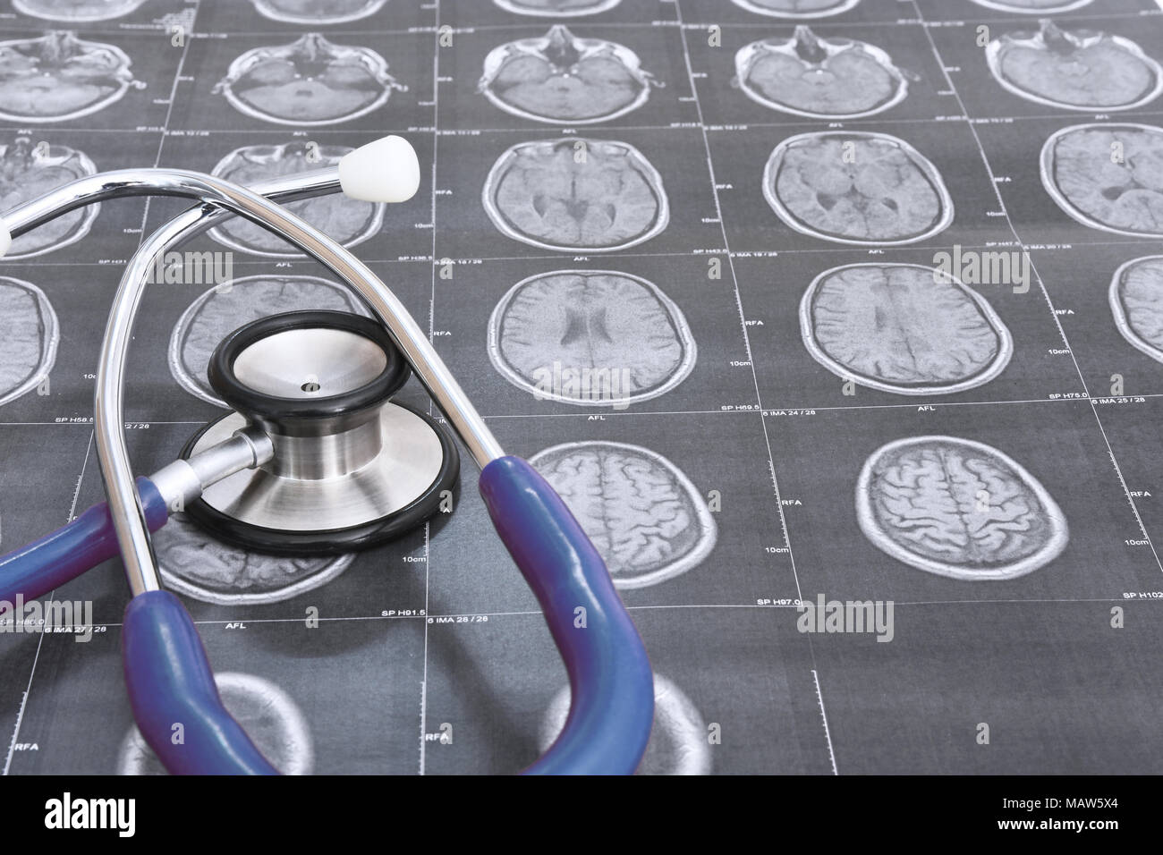 Perspective view of a MRI scan of the human brain (transverse view) and ...