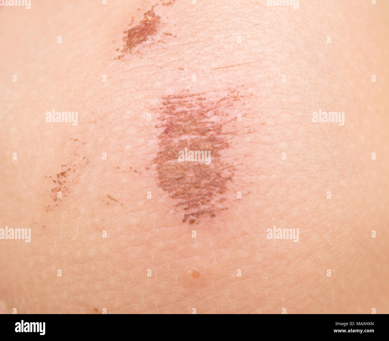 Injury on skin Stock Photo - Alamy