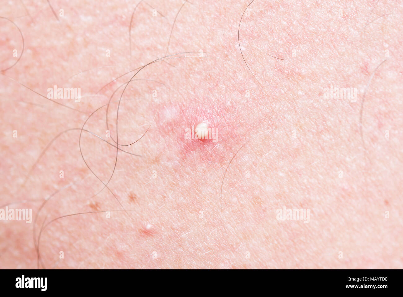 Pimple closeup skin texture hi-res stock photography and images - Alamy