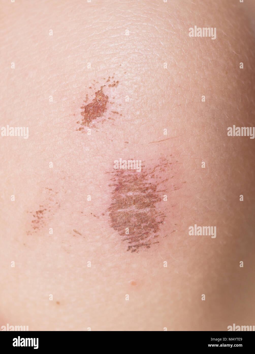 Injury on skin Stock Photo - Alamy