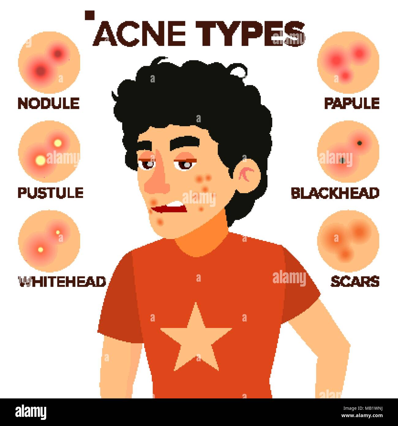 Acne Types Vector. Boy With Acne. Pimples, Wrinkles, Dry Skin ...