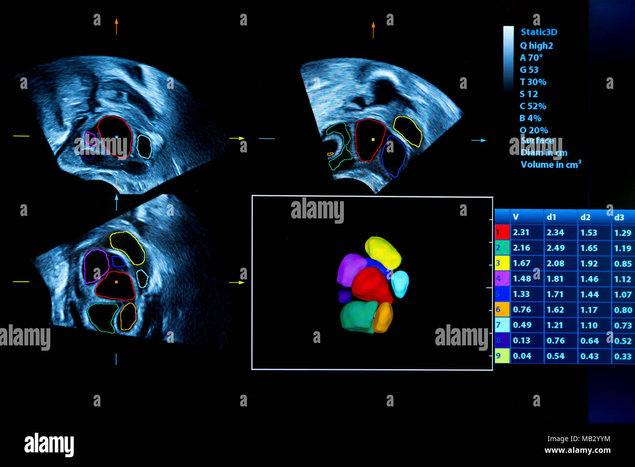 Colourful image of modern ultrasound monitor. Ultrasonography machine ...