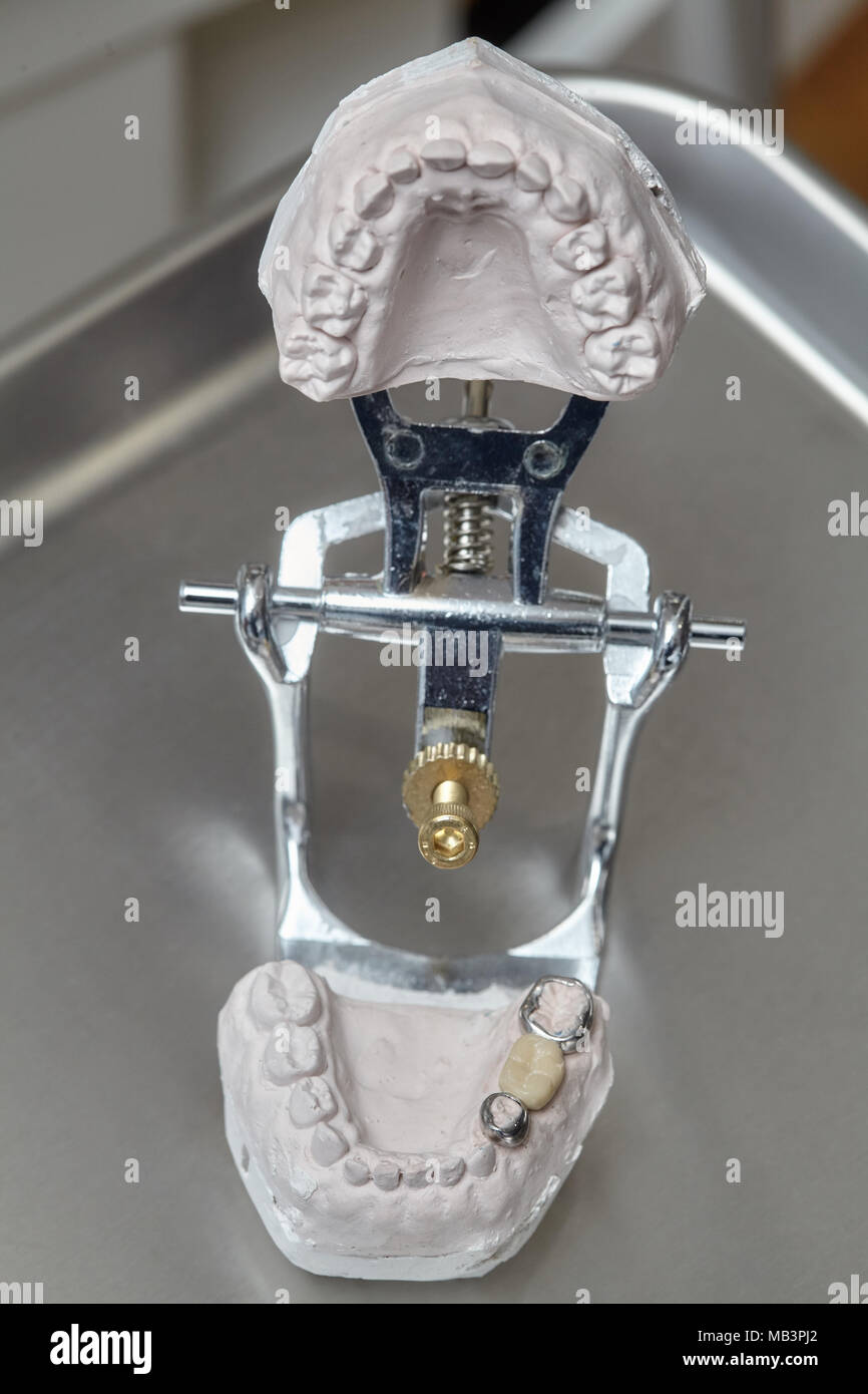 Gray dental prosthesis teeth mold, clay human gums model in jaws ...