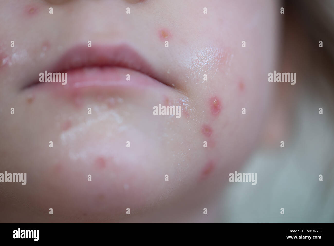 Chickenpox on the body of a little girls face, close up Stock Photo - Alamy