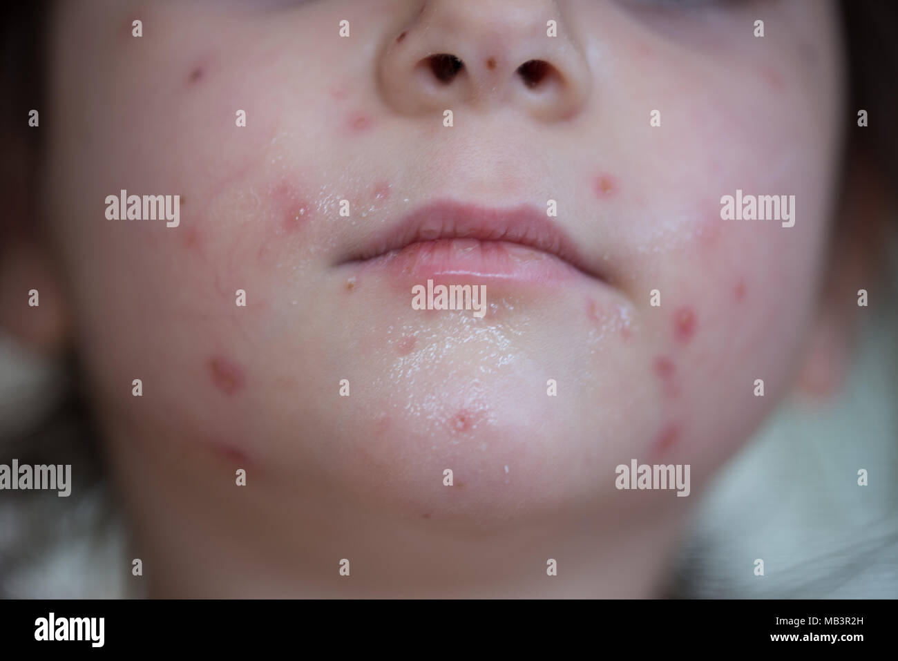 Chickenpox on the body of a little girls face, close up Stock Photo - Alamy
