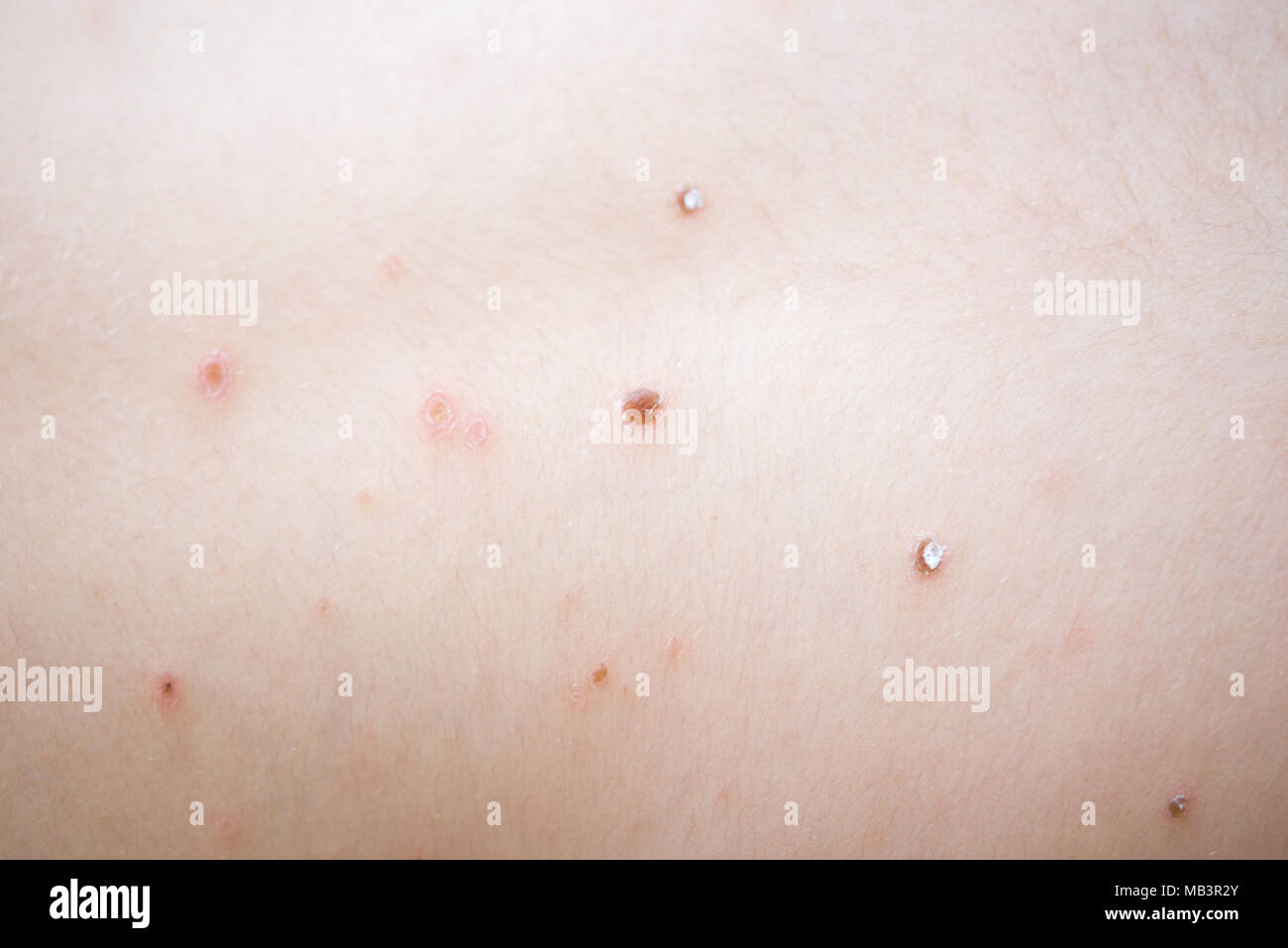 Chickenpox on the body of a young child, skin infection Stock Photo - Alamy