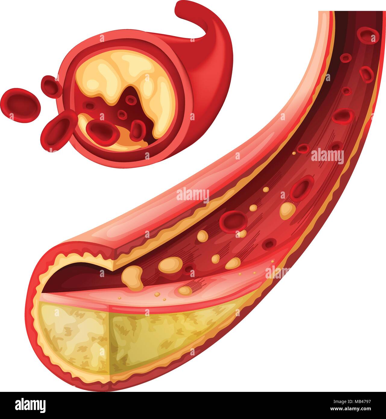 Fat in the blood Stock Vector Images - Alamy
